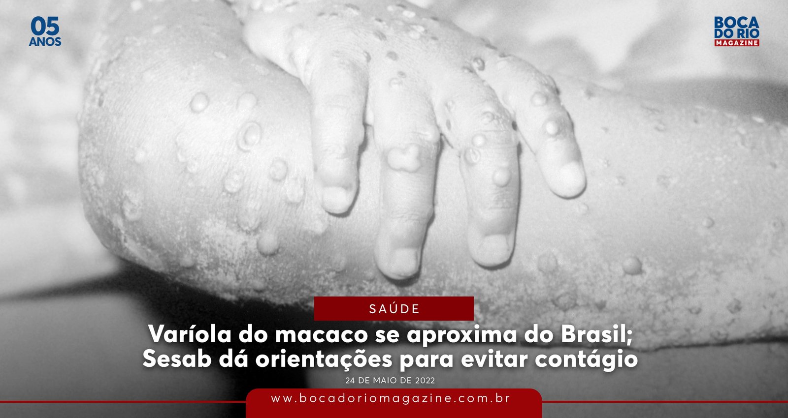 Varíola do macaco se aproxima do Brasil; Sesab dá orientações para ...