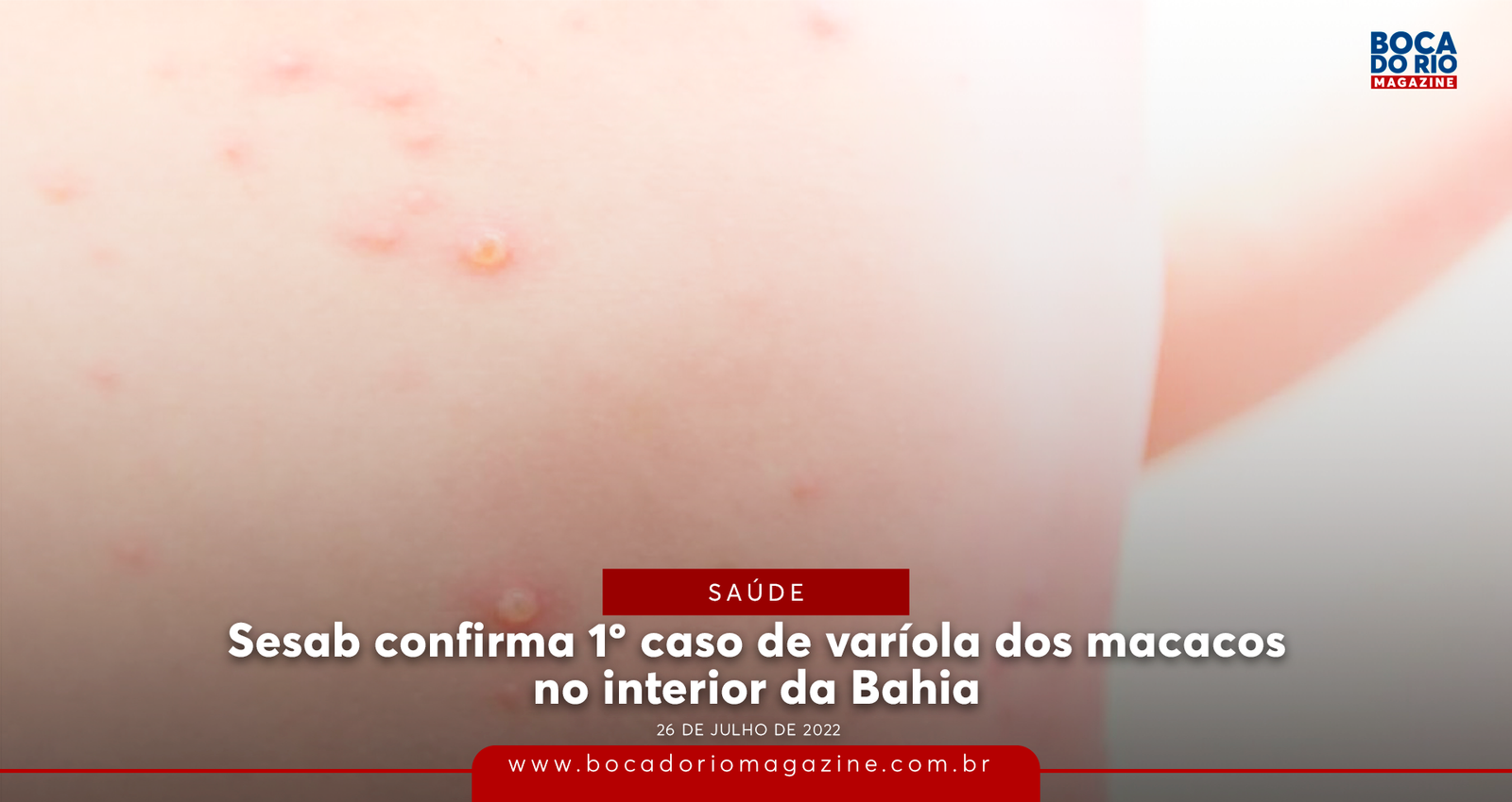 Sesab confirma 6º caso de varíola dos macacos na Bahia; veja detalhes ...